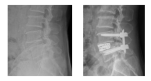 Minimally Invasive Lateral Lumbar Interbody Fusion